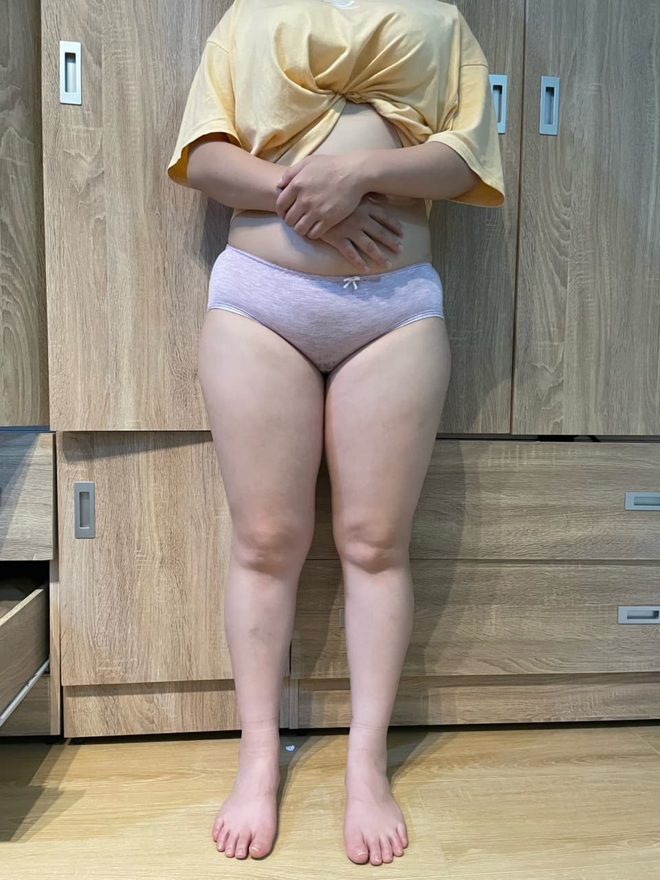 #分享 我不想再當米其林寶寶啦！！ - 晶美整形 (@skin1000) | Dcard