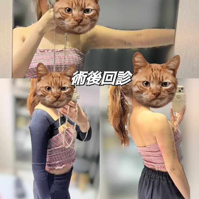 #分享 手臂抽脂 不是天生完美，但我想讓自己更接近理想 - 晶美整形 (@skin1000) | Dcard