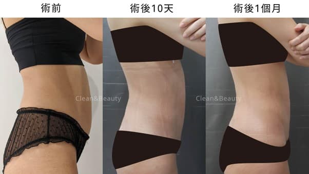 #分享 抽脂&超能電漿打造了我的翹臀 - 晶美整形 (@skin1000) | Dcard