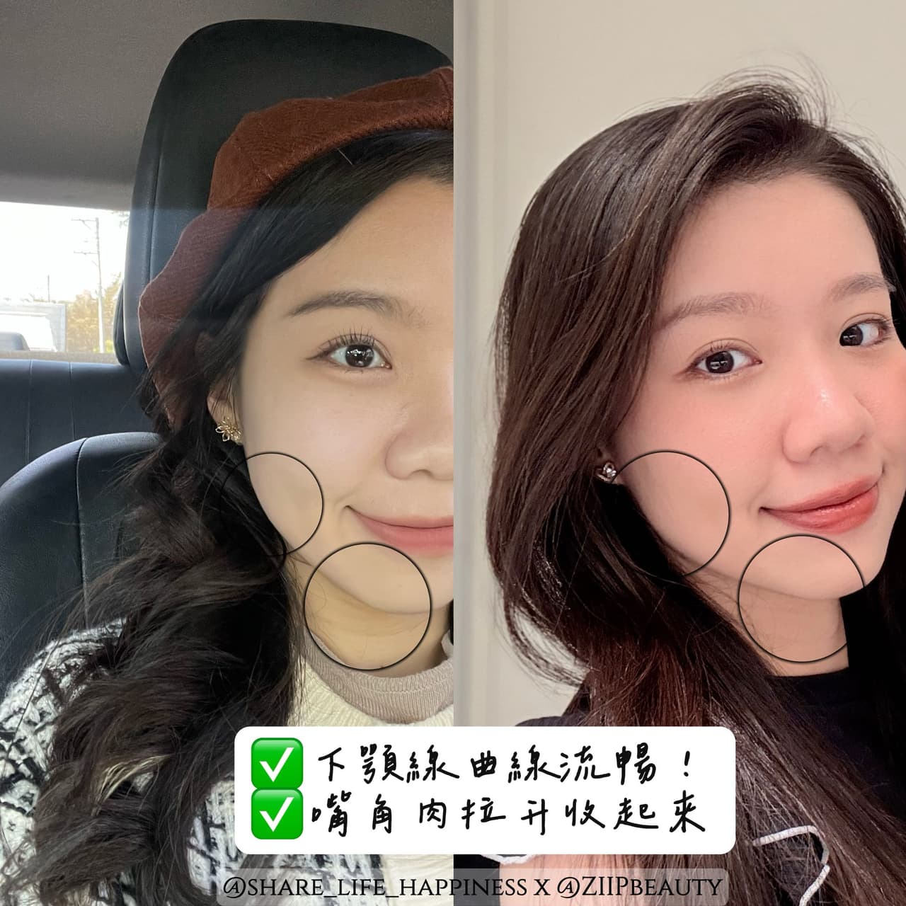 臉部線條偷偷回來了🌟｜ZIIP HALO美容儀輕鬆居家保養&提升緊緻 #真心話大告白 - 仙人掌🌵 (@bb105) | Dcard