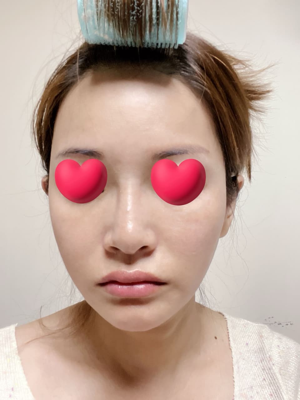 #分享 有感的皮秒雷射 - 醫美板 | Dcard