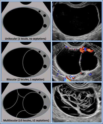 #婦科 超音波兩大良性腫瘤:肌瘤?水瘤? - 黃芃瑄醫師 • 婦產科 (@ogdr_huangph) | Dcard
