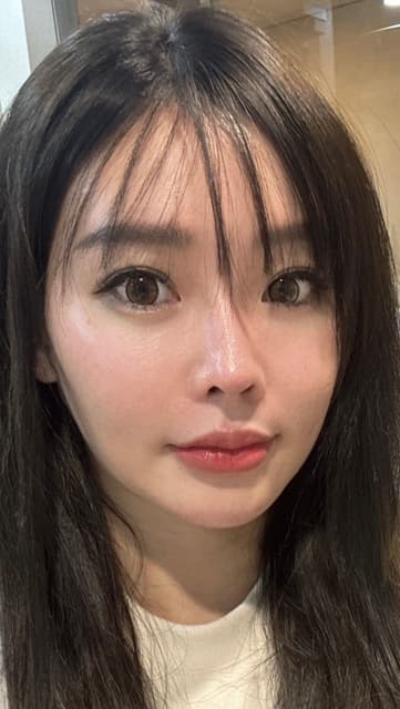 #分享 異體真皮(合法捐贈者的皮膚)，已成為不可忽視的填充新星! - 醫美板 | Dcard