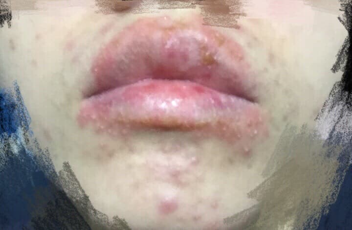 畢業痘痘大爆發 - B139 留言 | Dcard