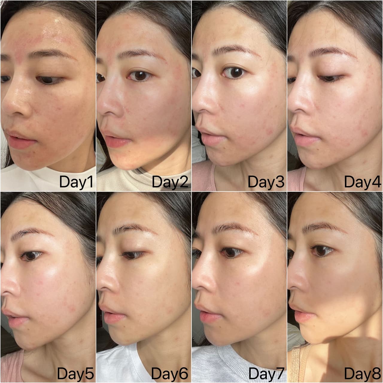 #分享 初次蜂巢皮秒 術後7日膚況紀錄 & 保養效果 - 醫美板 | Dcard