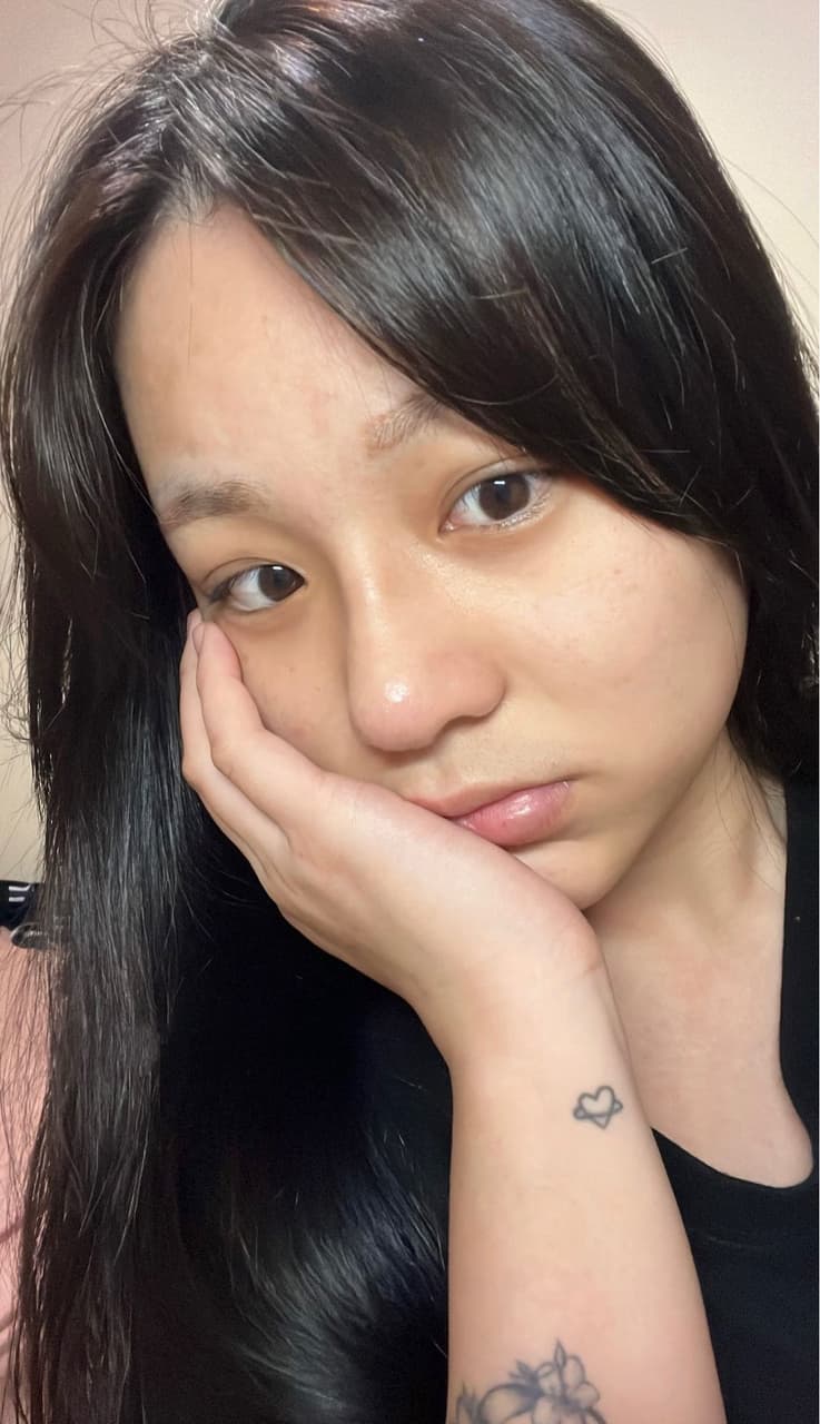 #分享 #圖多 #文長 終於去隆鼻啦！ - 醫美板 | Dcard