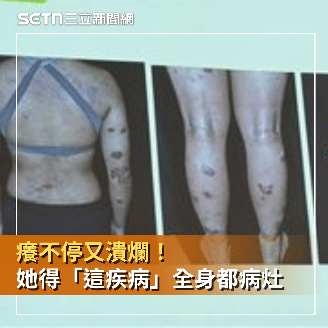 癢不停又潰爛！她得「1疾病」病灶遍及全身 醫嘆：一停藥就大爆發 - SETN三立新聞網 (@setn54) | Dcard
