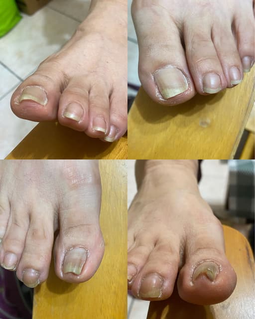 問題 卷甲治療? 美甲板 Dcard