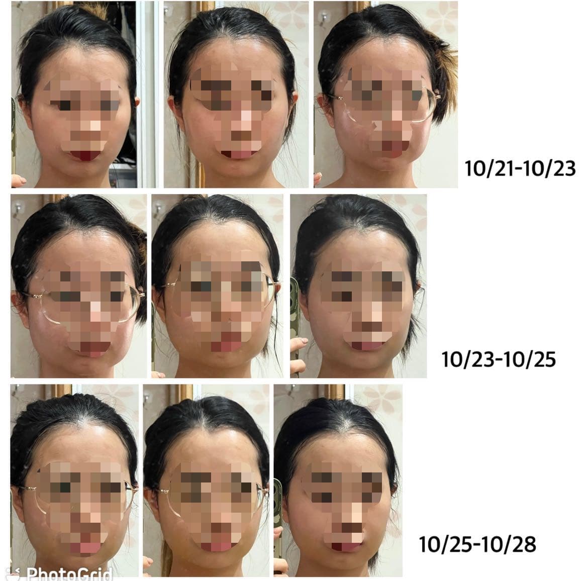 #分享 #海芙三代 #音波 一個月術後心得 - 醫美板 | Dcard