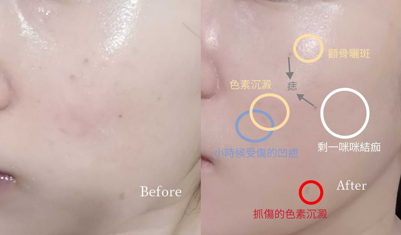 #分享 雀斑救星🎉 雷射過程、術後9天紀錄(Discovery Pico＋Ruby Quanta) - 醫美板 | Dcard