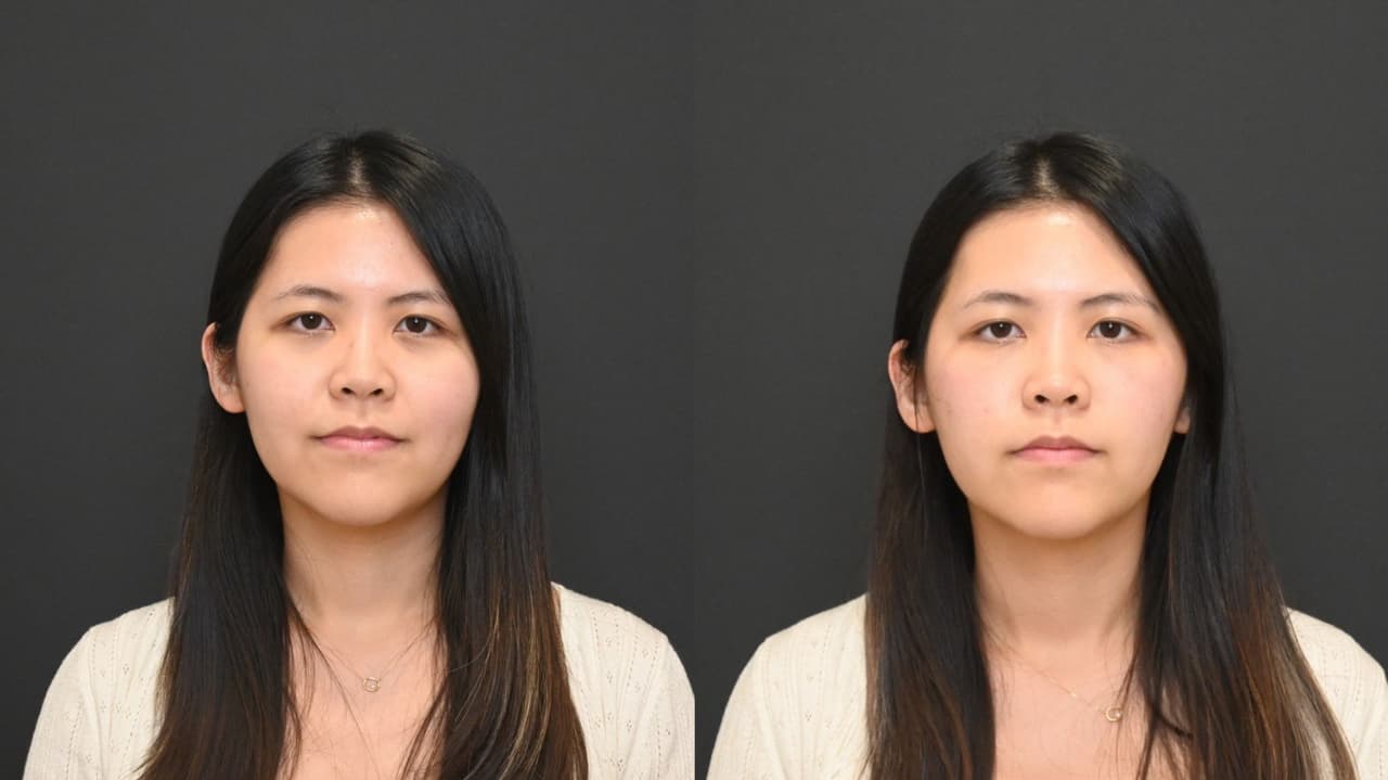 #分享 24歲第一次醫美 保柔緹玻尿酸2cc心得 - 醫美板 | Dcard