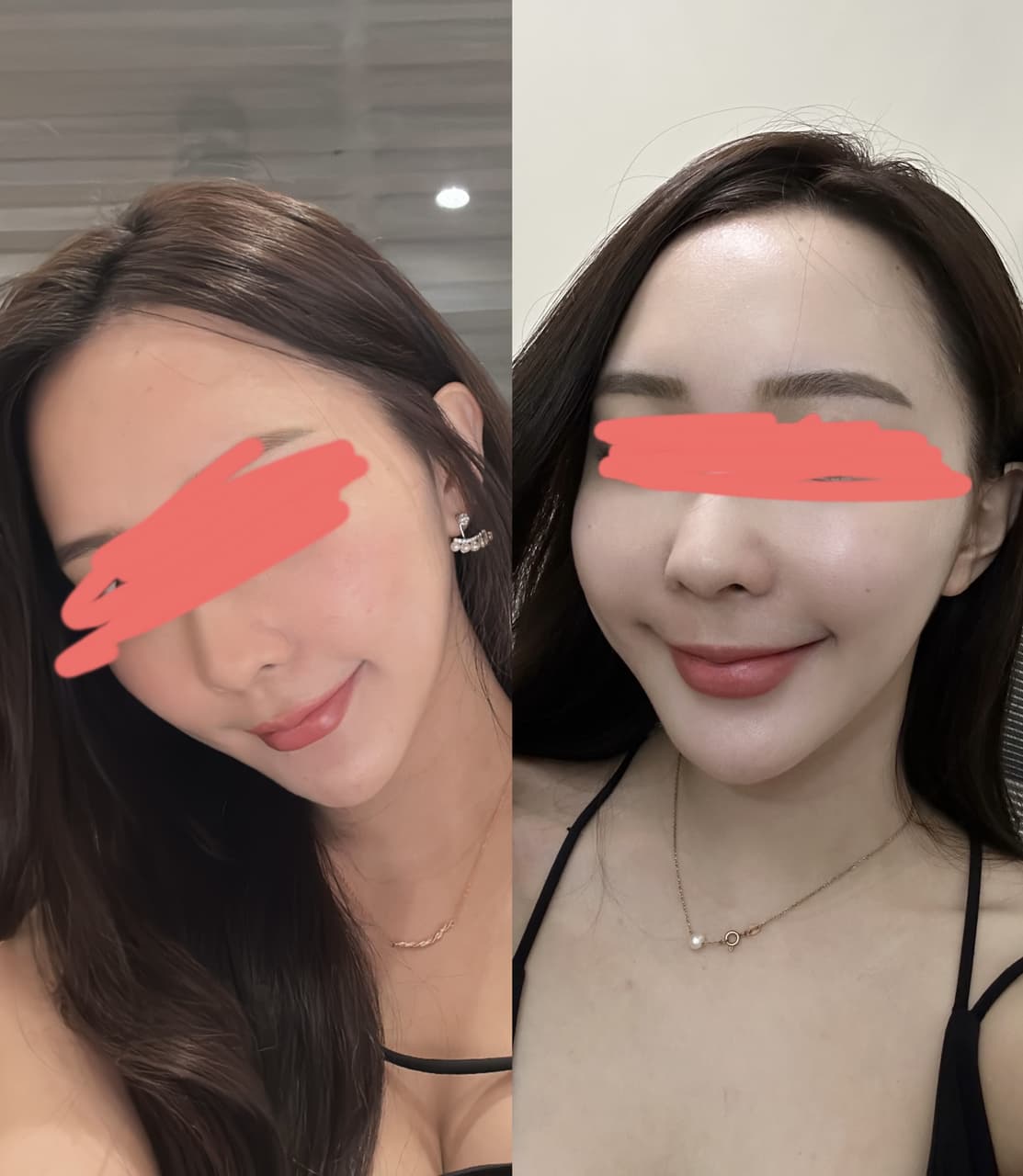 #分享 矯正失敗內傾，美白陶瓷貼片拯救了我的笑容 - 女孩板 | Dcard