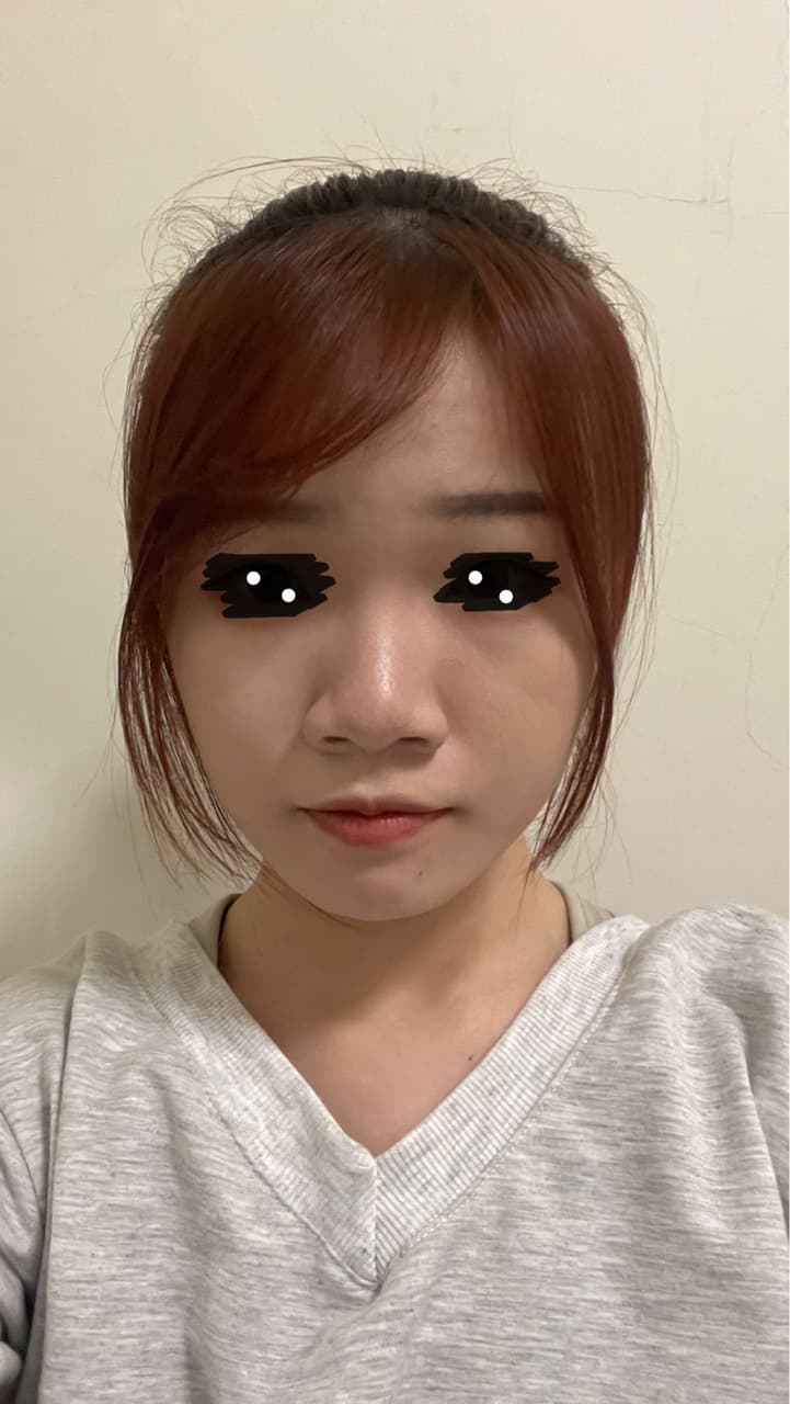 #討論 敲鼻骨 - 醫美板 | Dcard