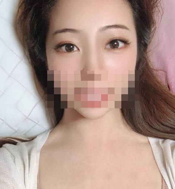 #分享 籌備婚禮前的眼袋手術🤩 - 醫美板 | Dcard