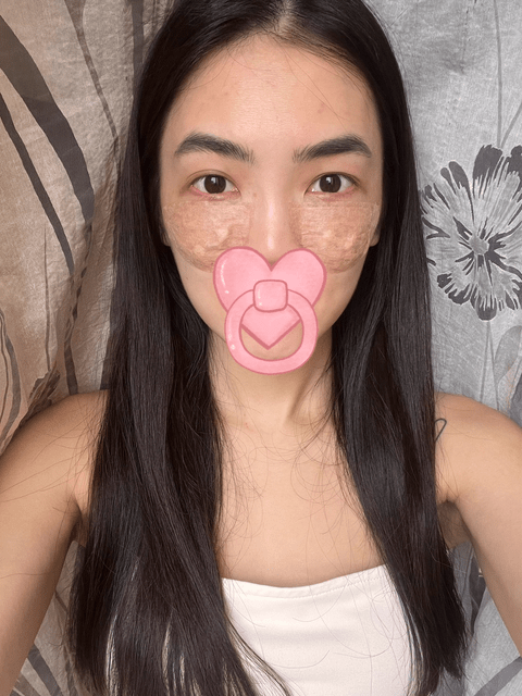 #分享 眼袋手術讓我煥然一新💝 - 醫美板 | Dcard