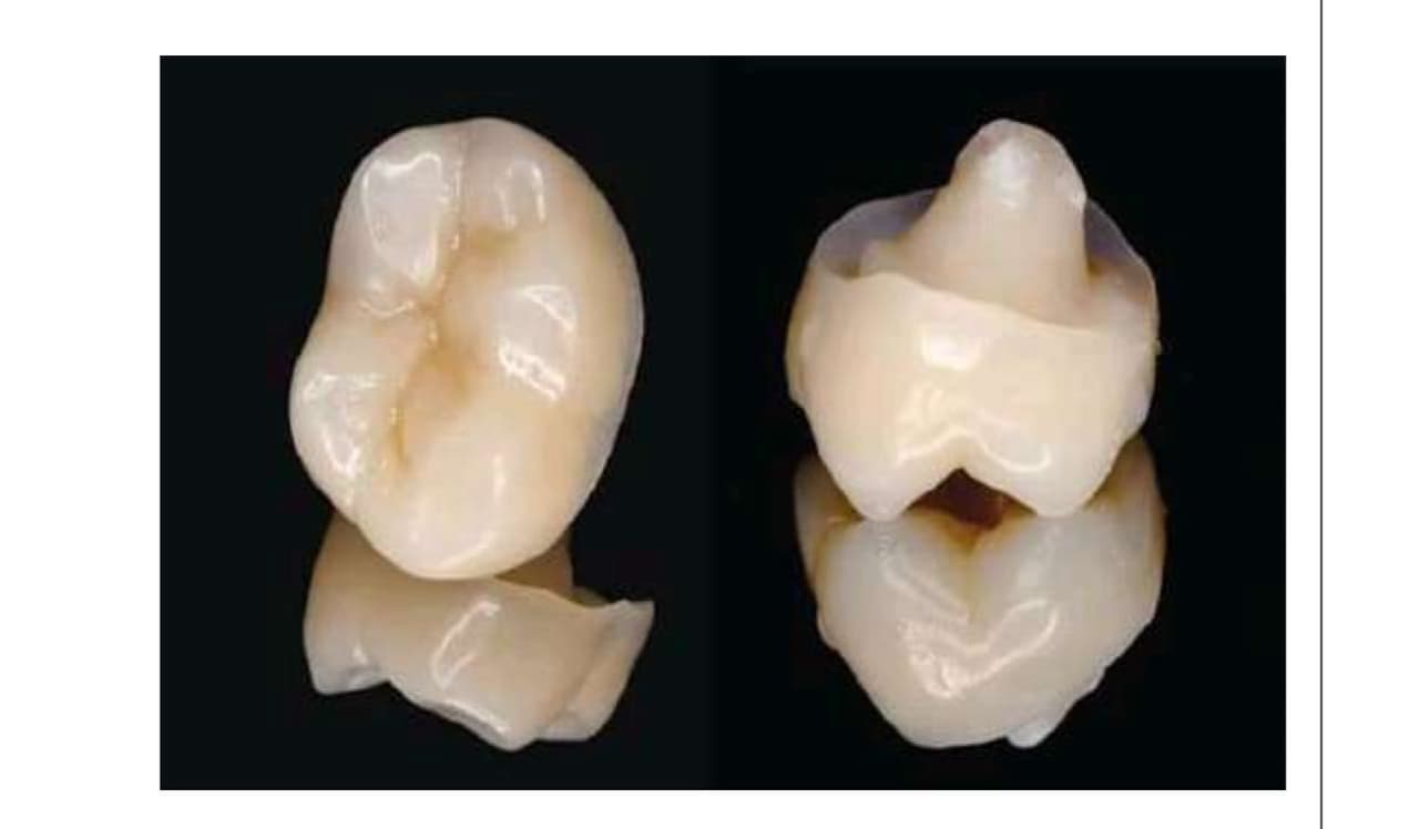 請益 關於下排大臼齒顯微根管治療後的專用Endo Crown - 牙齒矯正板 | Dcard