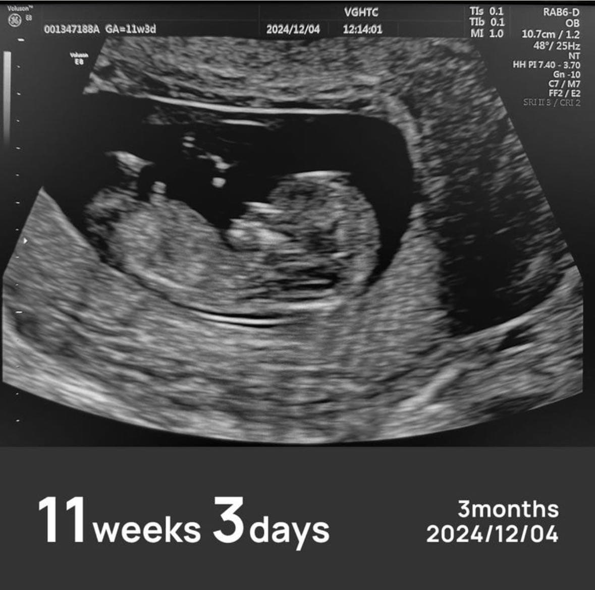 #懷孕 從確定懷孕到第五個月心得分享 - 親子板 | Dcard