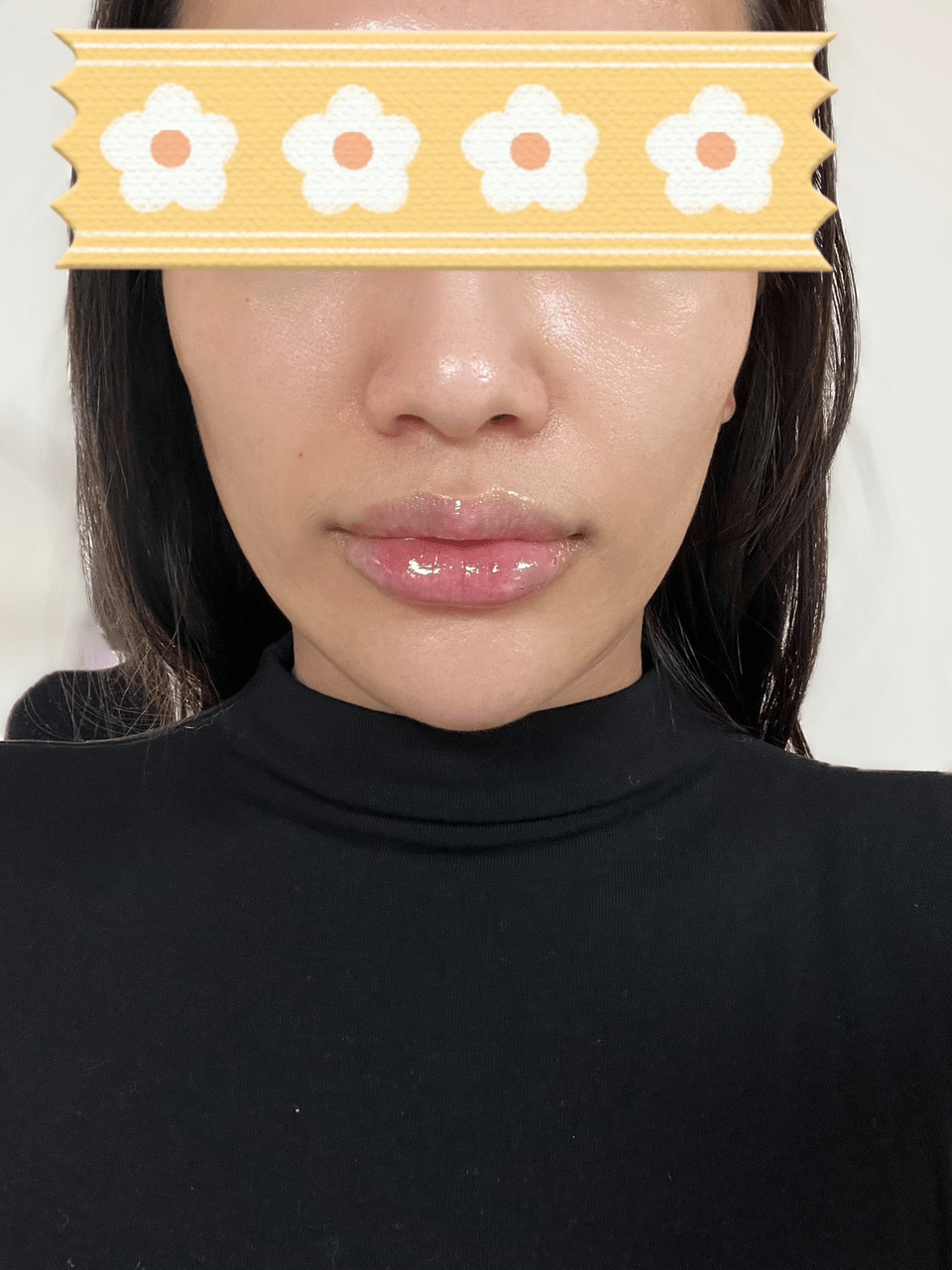 #詢問 頰凹該打什麼比較好 - 醫美板 | Dcard