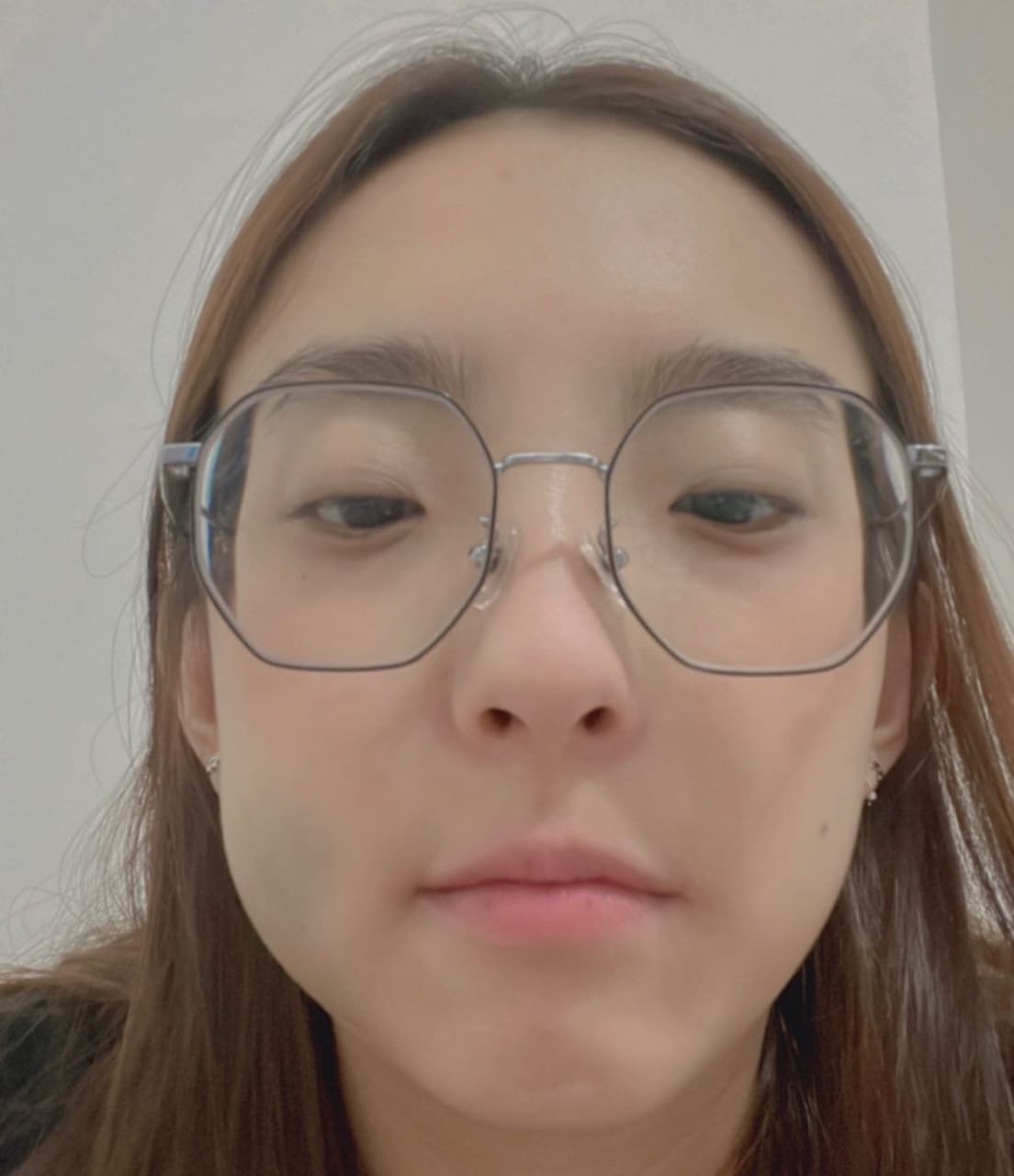 拔智齒臉腫成包子 - 有趣板 | Dcard