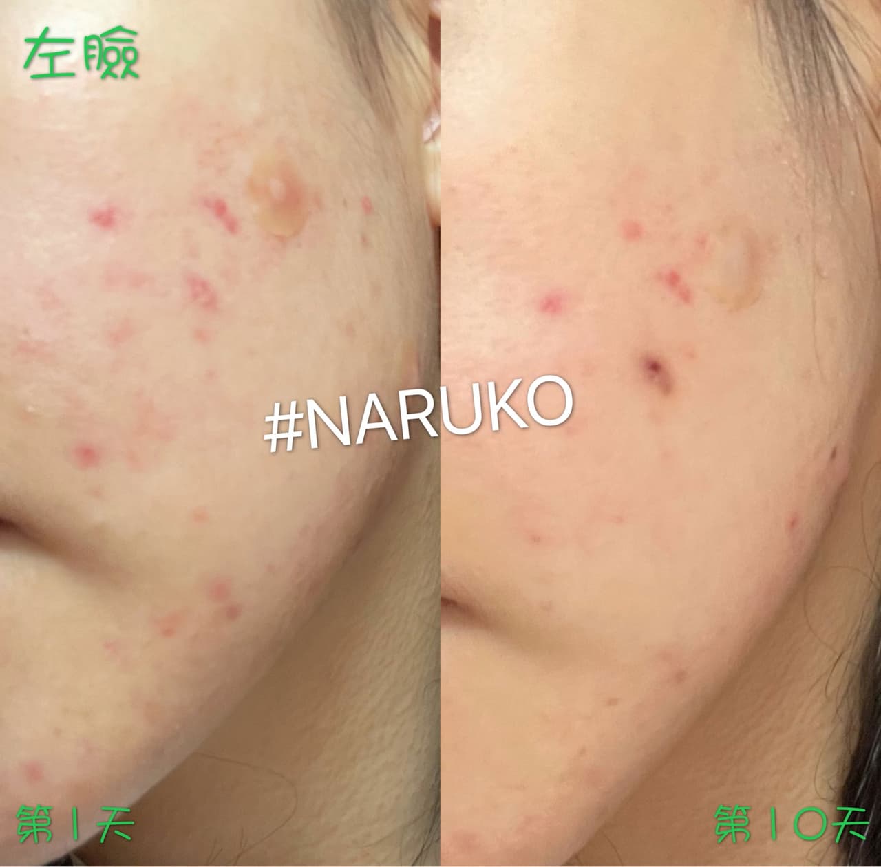 如果你有痘印，一定要試試它！ - 贊助板 | Dcard