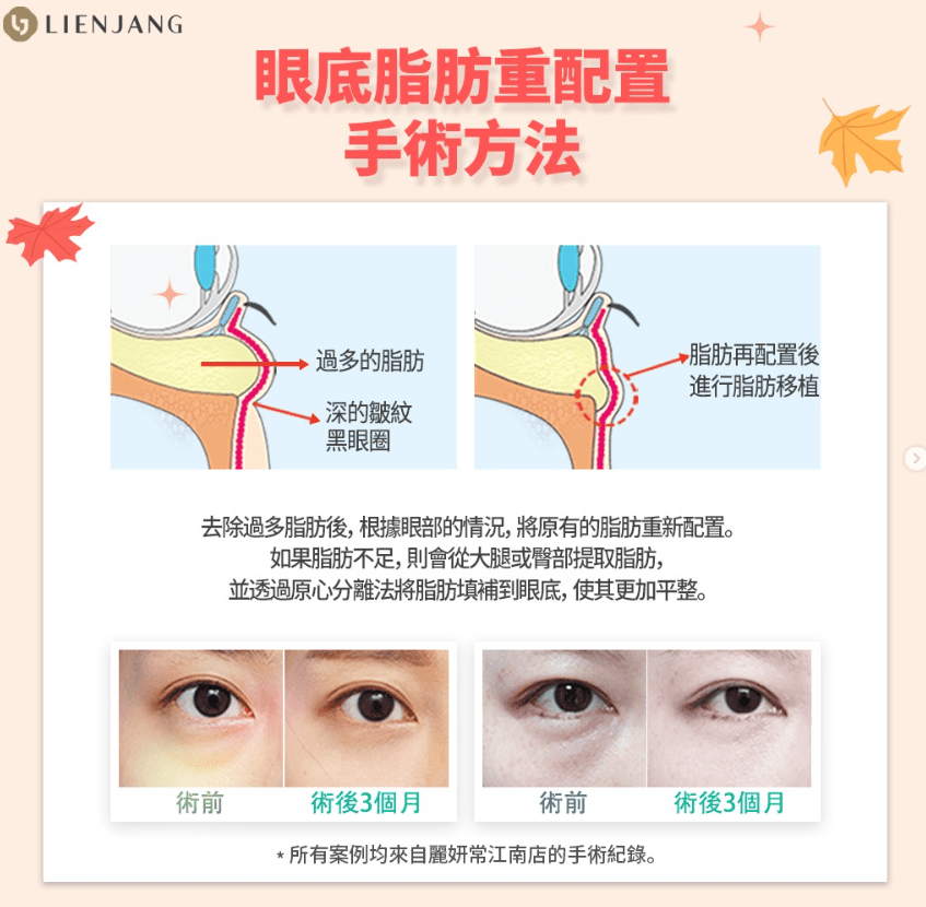 眼袋消失術 麗妍常招牌 眼底脂肪重配置💖 - 韓國醫美 麗妍常 (@lienjang) | Dcard