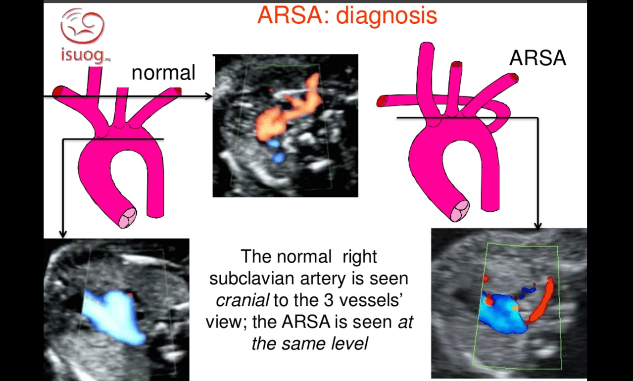 #懷孕 淺談迷走性右鎖骨下動脈(ARSA) - 親子板 | Dcard