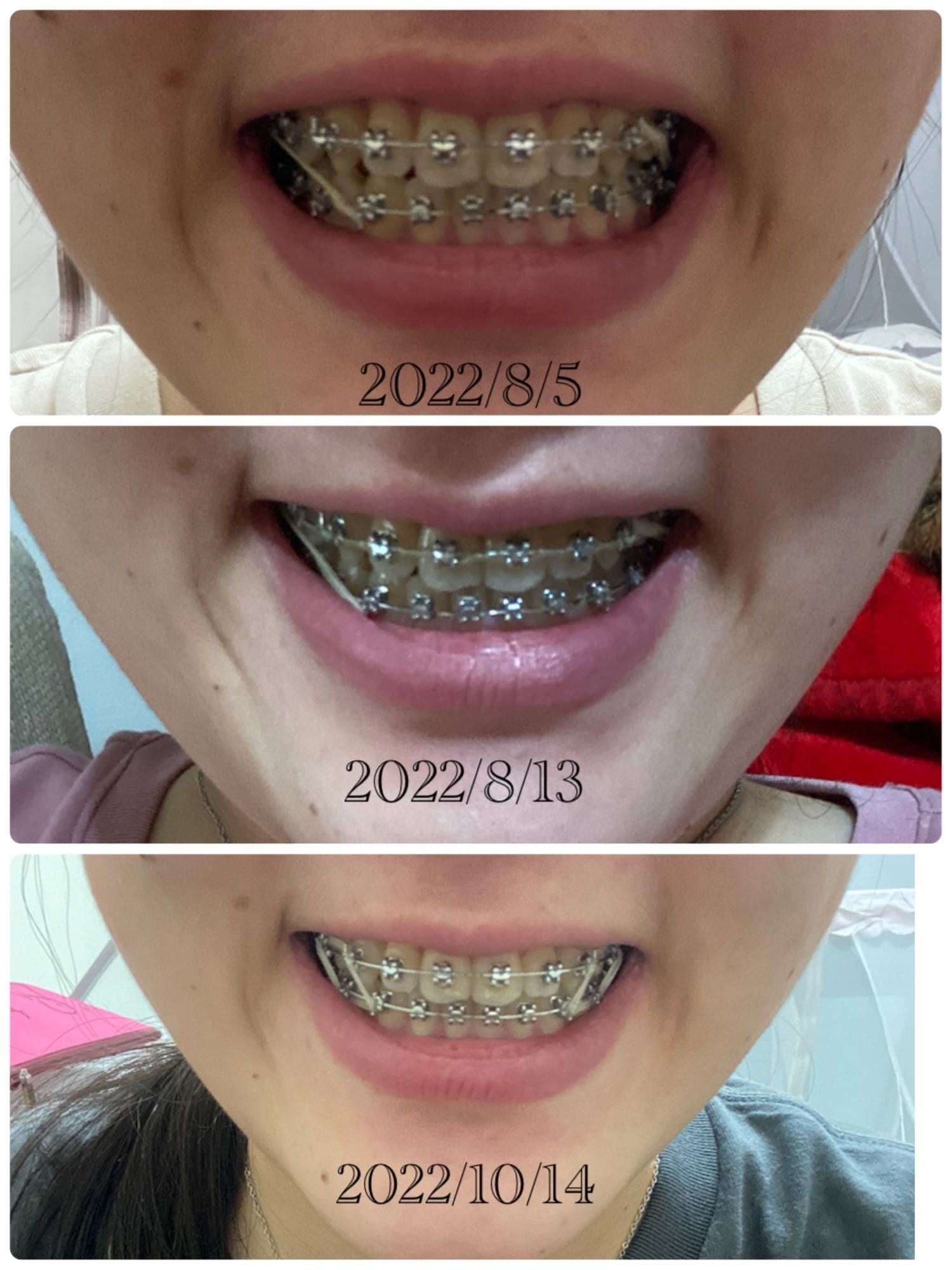 戽斗純牙套矯正 - 牙齒矯正板 | Dcard