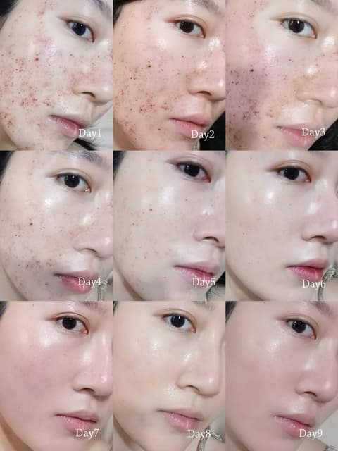 #分享 雀斑救星🎉 雷射過程、術後9天紀錄(Discovery Pico＋Ruby Quanta) - 醫美板 | Dcard