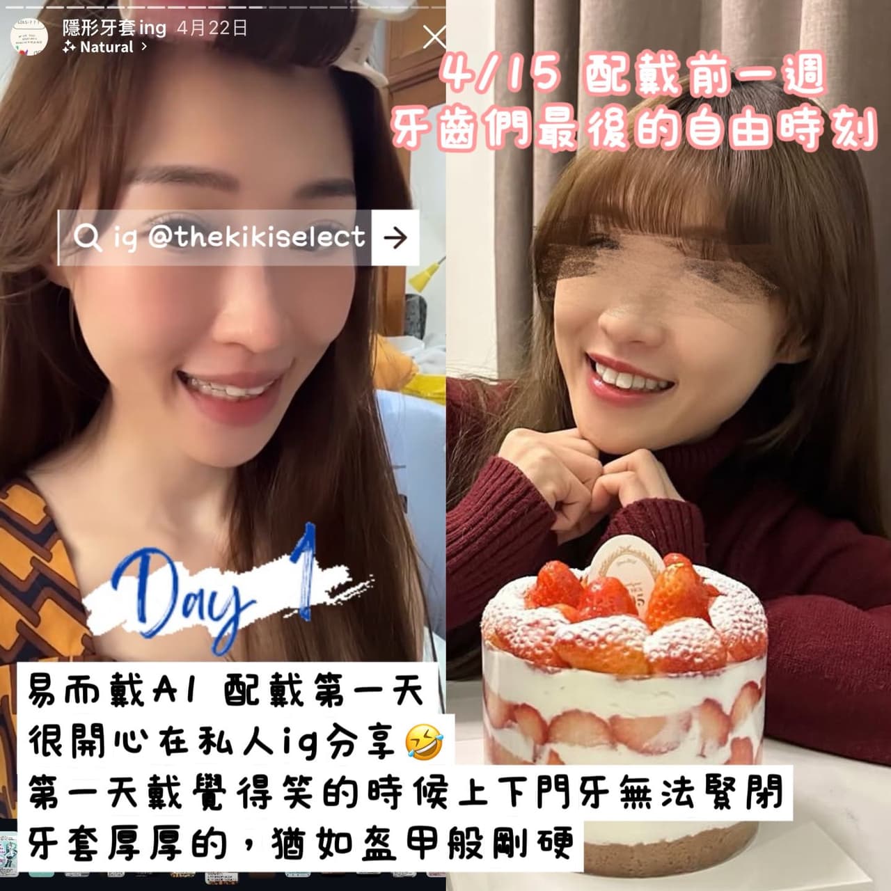 終於開始的矯正⼈⽣ 隱形牙套易⽽戴A1～A5 記錄分享 - 牙齒矯正板 | Dcard