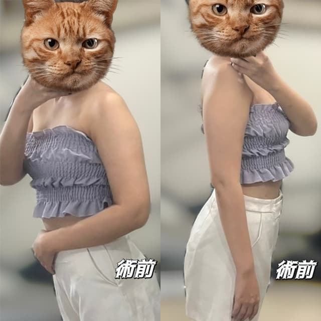 #分享 手臂抽脂 不是天生完美，但我想讓自己更接近理想 - 晶美整形 (@skin1000) | Dcard