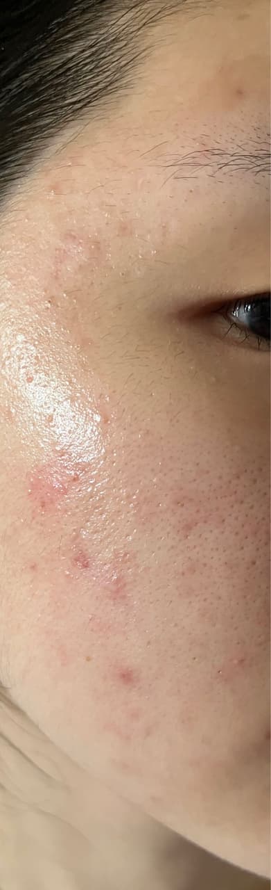 #分享 擦A酸的皮膚轉變 - 美妝板 | Dcard