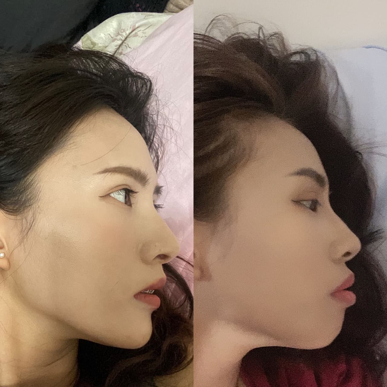 #分享 矯正快三年的側臉變化 - B116 留言 | Dcard