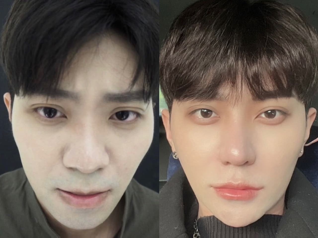 #分享 做了隆鼻和法令紋貴族手術好像換了一張臉 - B330 留言 | Dcard