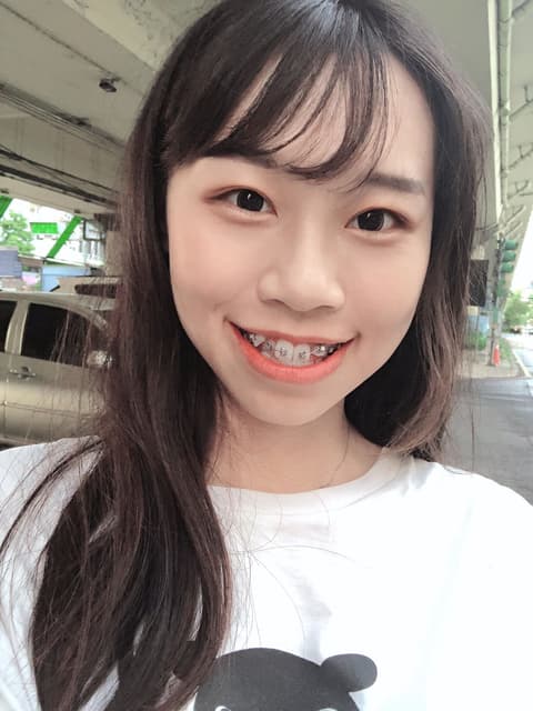 骨性戽斗純矯正│半年多分享 - B83 留言 | Dcard
