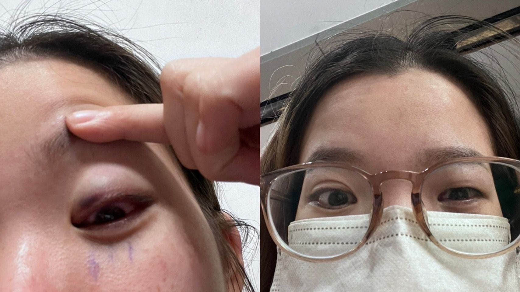 #分享 提眼肌手術，眼睛變有神了！ - 醫美板 | Dcard