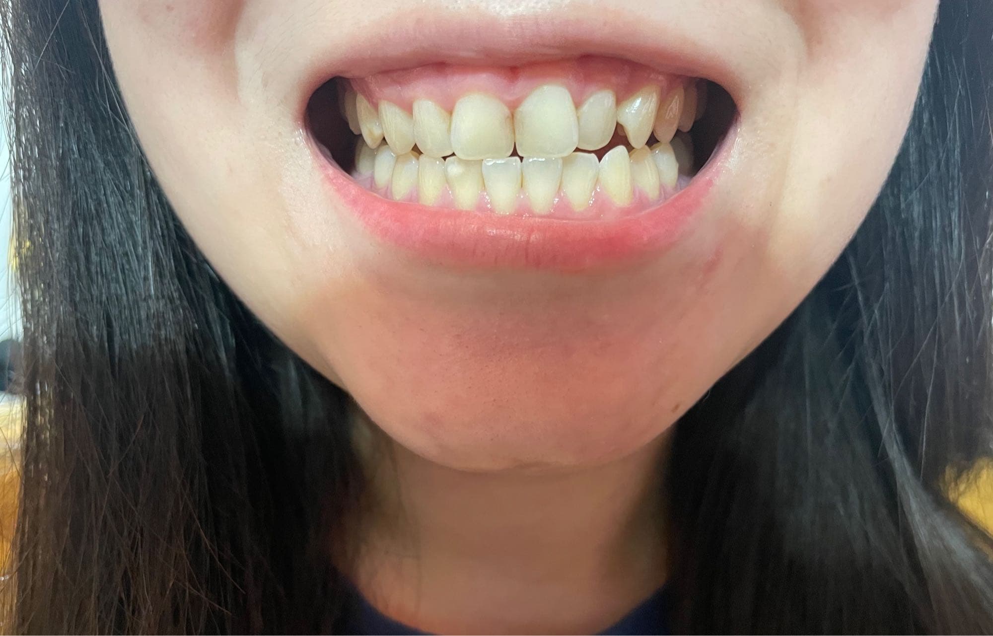 門牙樹脂補牙變色 - 牙齒矯正板 | Dcard