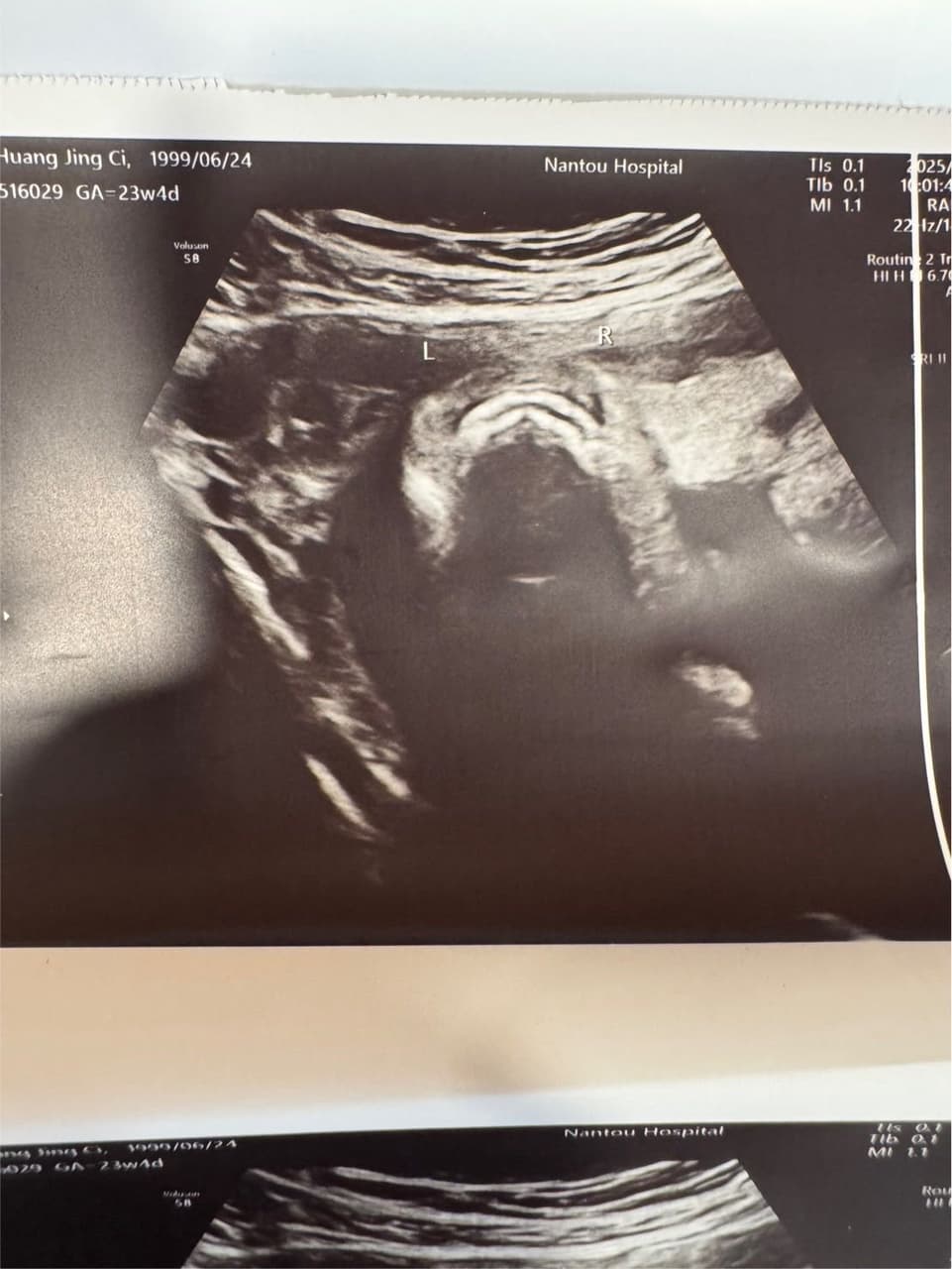 #懷孕 懷孕 超音波照#想知道是上顎還是下顎 - 親子板 | Dcard