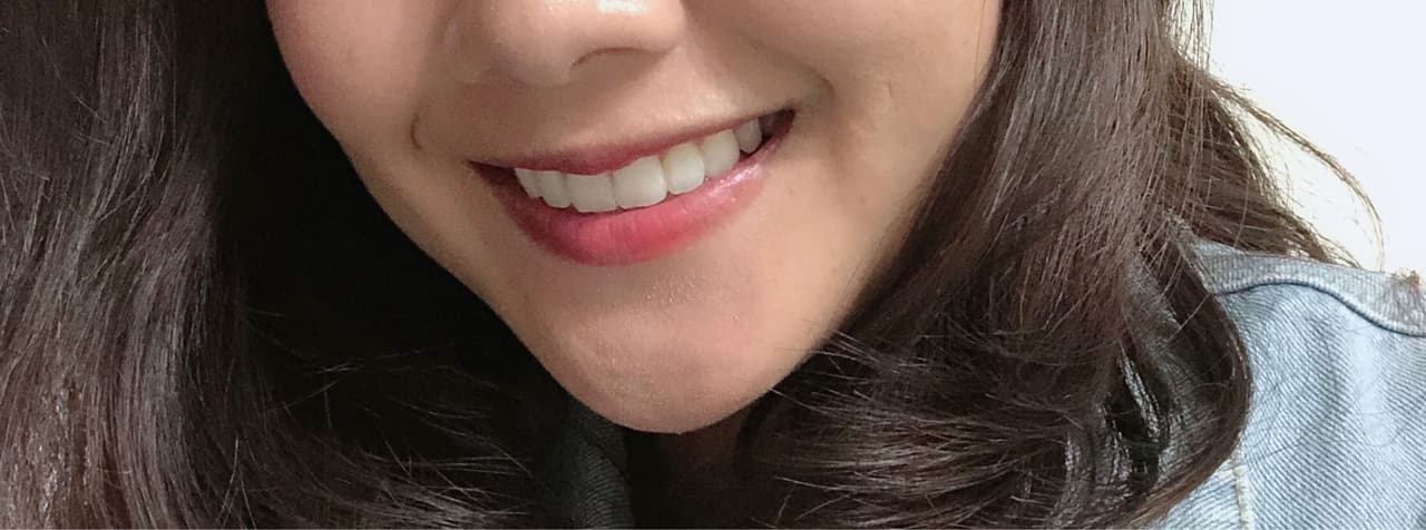 矯正牙齒全記錄！ - B282 留言 | Dcard