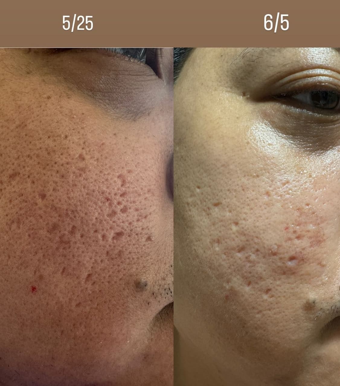 #討論 分享 ｜ 幫先生用TCA及早C晚A保養 - 美妝板 | Dcard