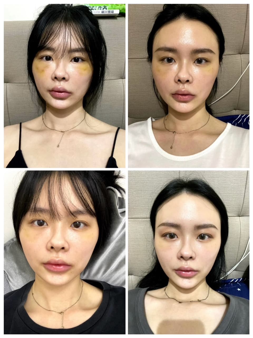 #分享 疲態泡泡眼Out!最強視覺減齡術之時尚假期醫美整形無痕眼袋 - 品牌商家 (@brand_selection) | Dcard