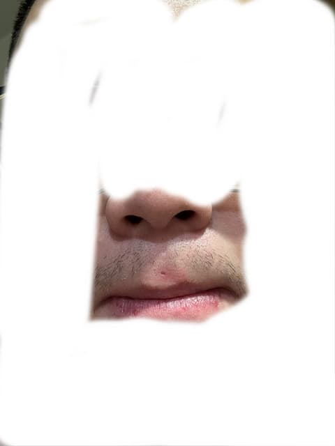 #分享 分享TCA治療痘疤 - 醫美板 | Dcard