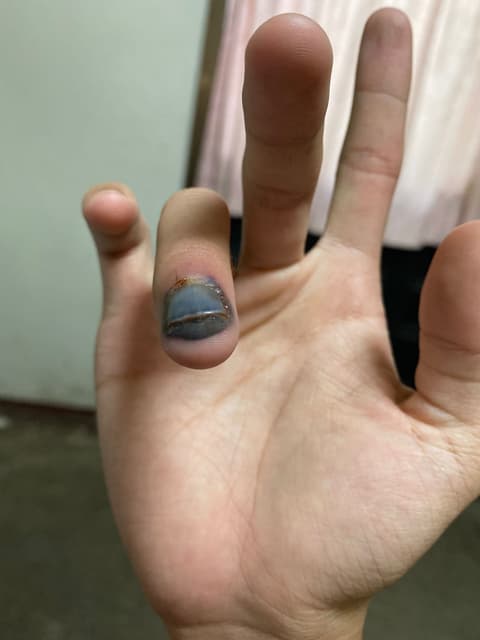 指甲瘀青 (有圖,甚入) 閒聊板 Dcard