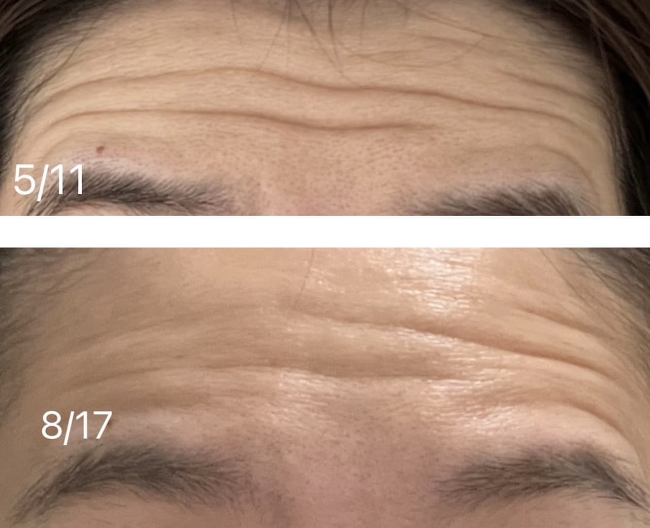 A醇擦3個月的前後對比照 - 喜歡簡單保養的商品開發 (@davin1982) | Dcard