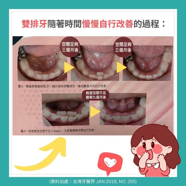 小朋友「長雙排牙齒」怎麼辦？要拔？不拔？ - 舊「魔法兔健康冷知識」 (@magictooth) | Dcard