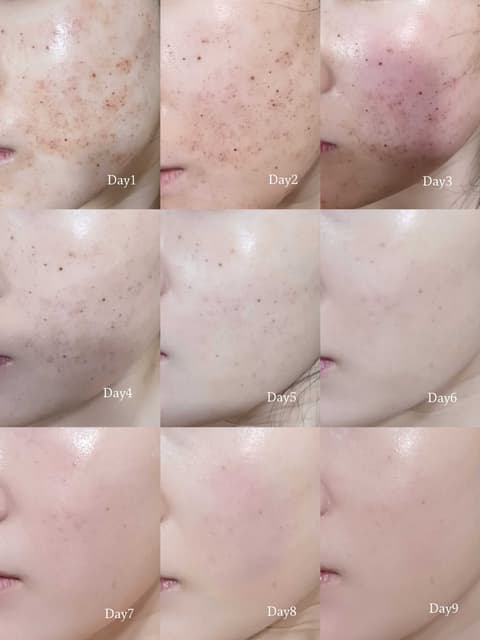 #分享 雀斑救星🎉 雷射過程、術後9天紀錄(Discovery Pico＋Ruby Quanta) - 醫美板 | Dcard