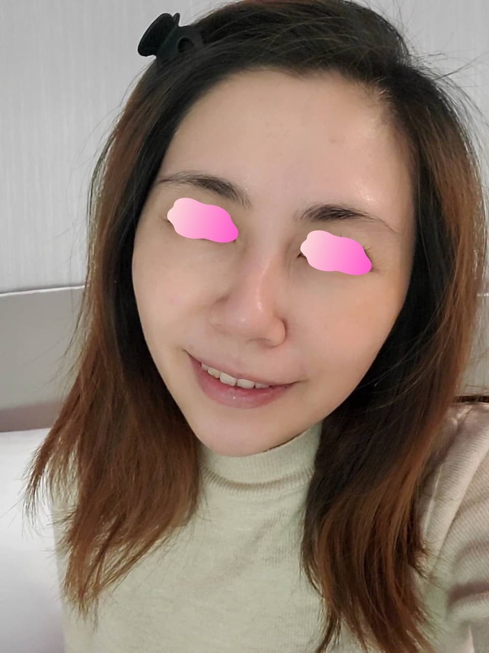 #分享 膠原蛋白增生劑初體驗！臉真的有在聽話變澎耶～下巴也偷偷出來見客了 - 醫美板 | Dcard