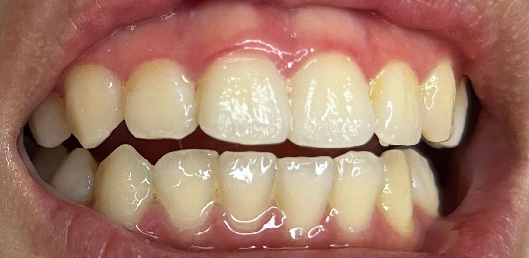 #分享 Crest牙貼好用 - 醫美板 | Dcard