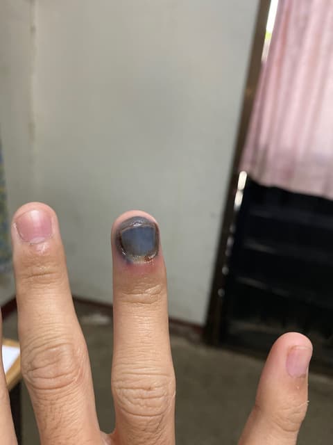 指甲瘀青 （有圖，甚入） 閒聊板 Dcard