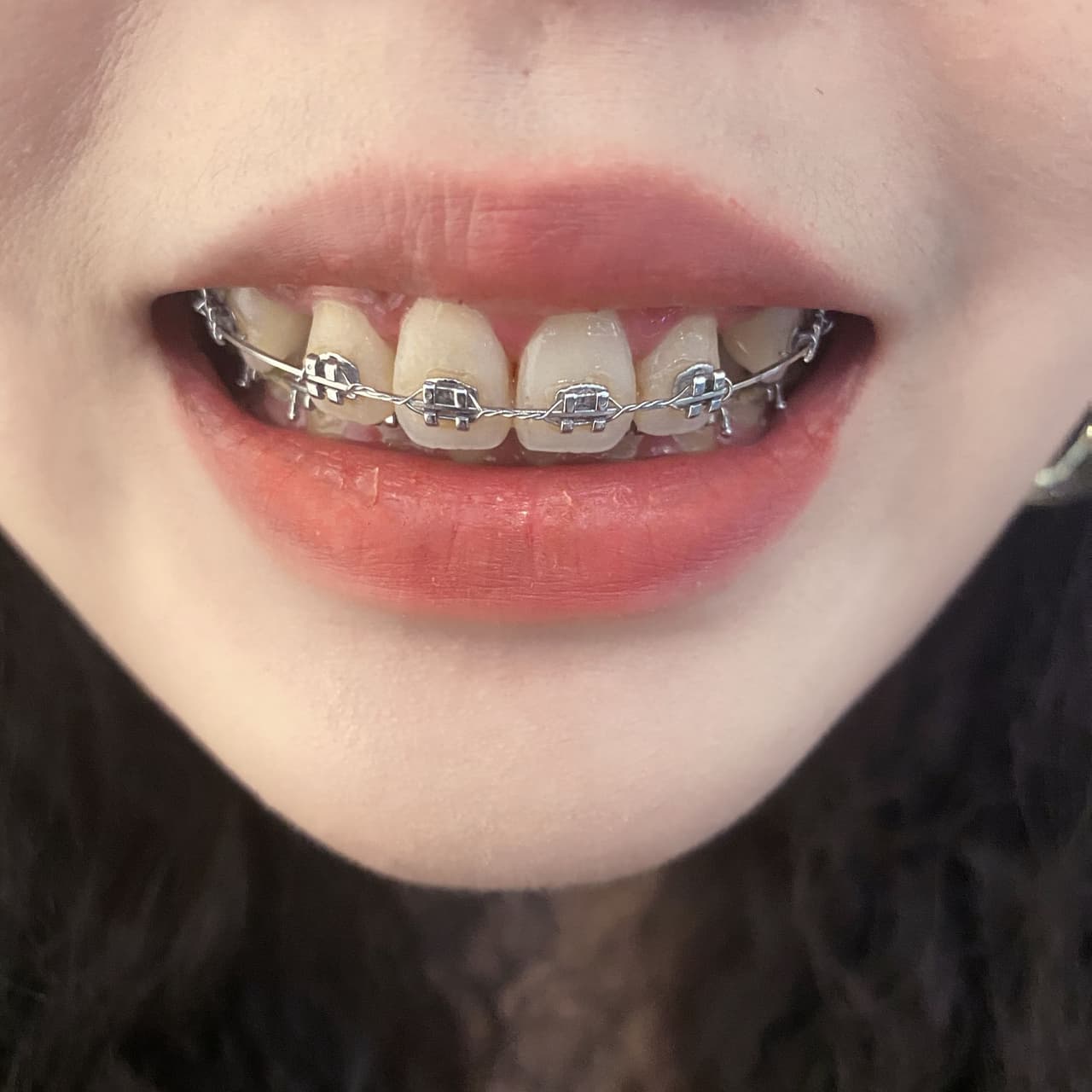 矯正牙齒全記錄！ - B273 留言 | Dcard