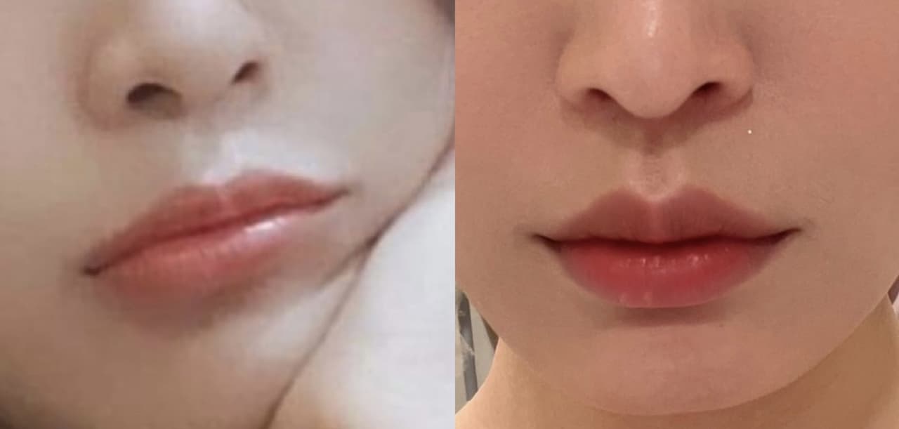 #分享 玻尿酸微笑唇 豐唇後像舒淇? - 醫美板 | Dcard